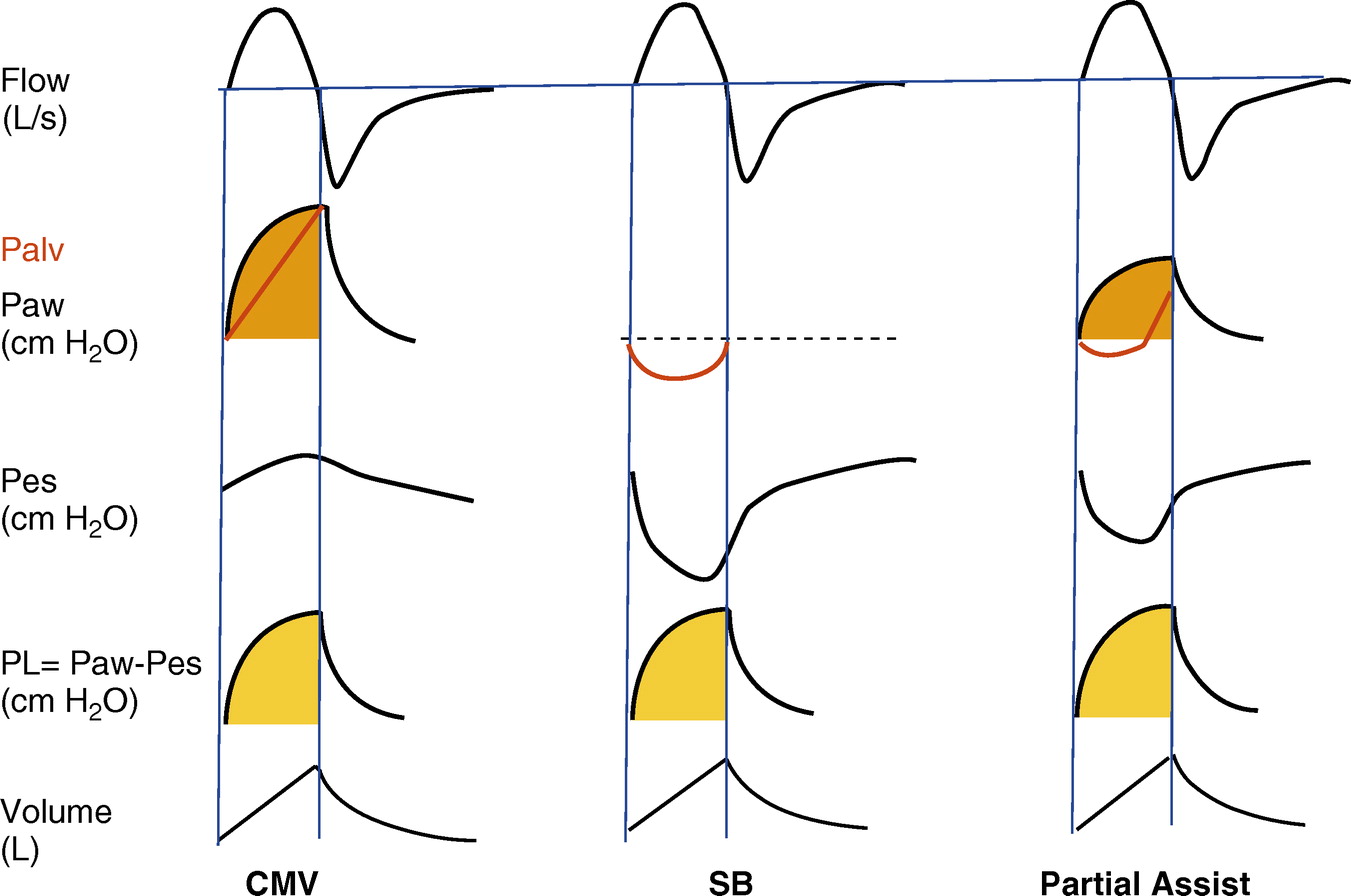 Ventilación mecánica para minimizar la injuria pulmonar | Campus Kinesico