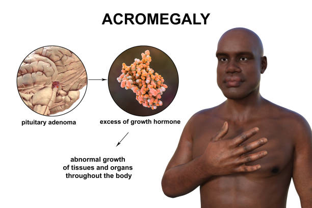 Acromegalia